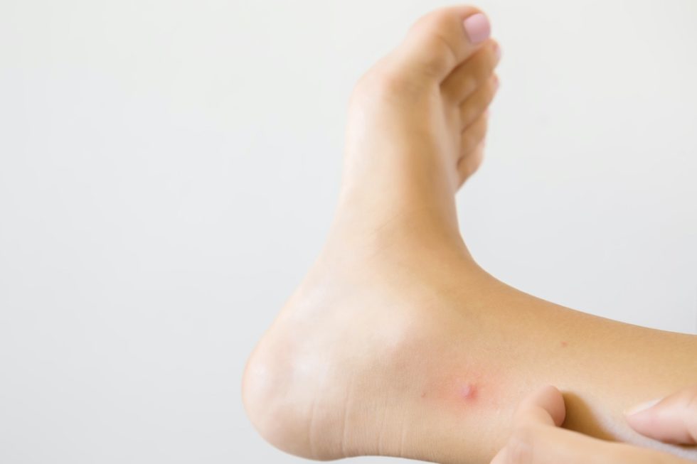 Symptoms - Alpha-gal Information